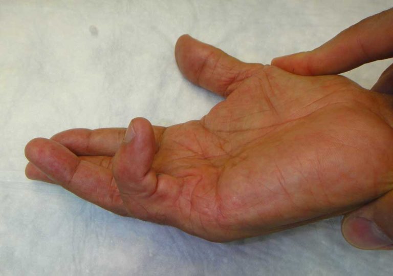 Injectable Clostridium Histolyticum Collagenases for Mild Dupuytren’s ...